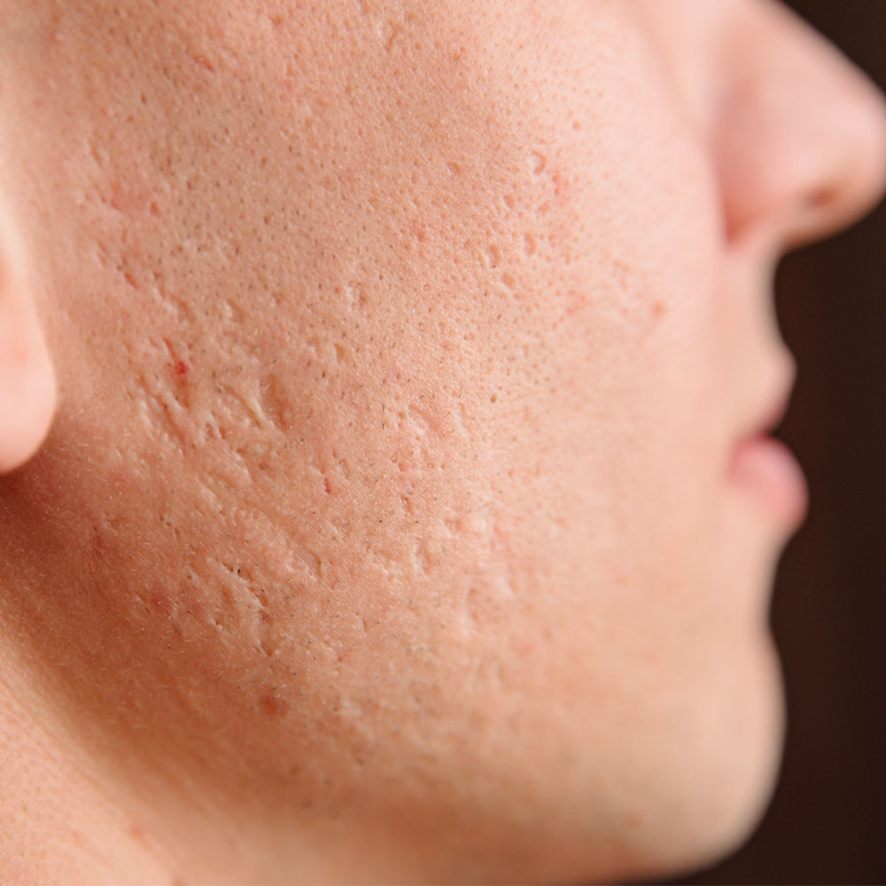Acne Scarring – SkinLab