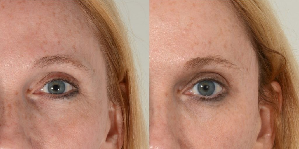 “Contour” treatments, creating shape – SkinLab